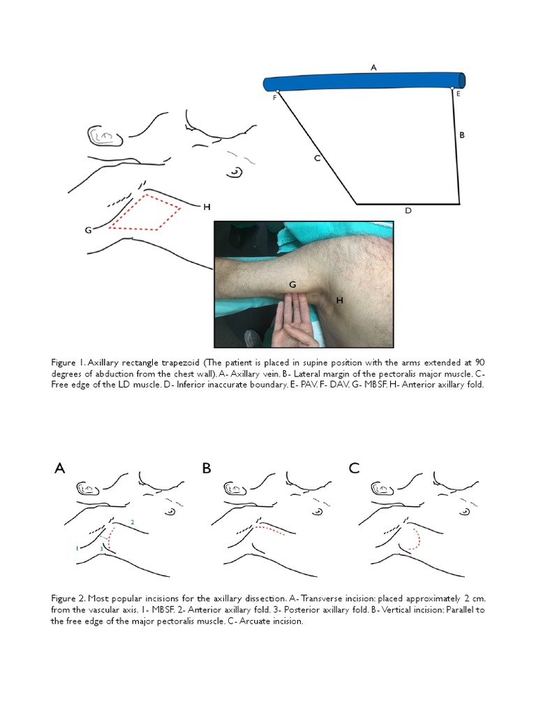Surgical Anatomy and Operative Technique of The Axillary Lymph Node ...
