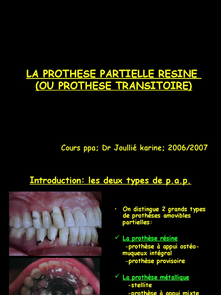 Prothèse Partielle Résine Transitoire | PDF | Dentiers | Branches de la ...