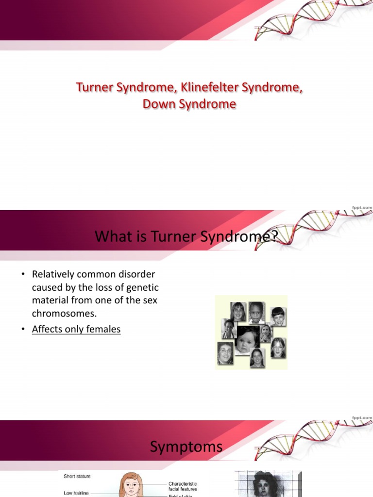 Turner Syndrome, Klinefelter Syndrome,Down Syndrome.pptx | In Vitro ...