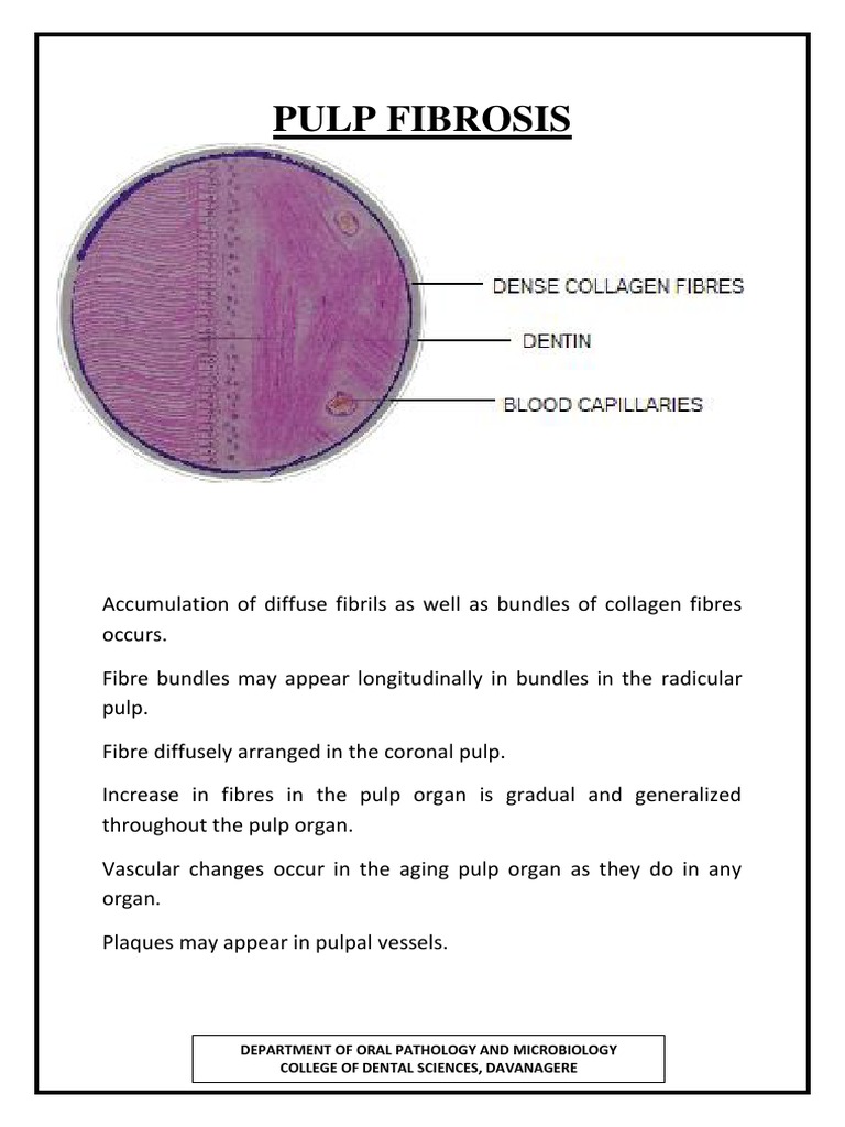 Pulp Fibrosis | PDF
