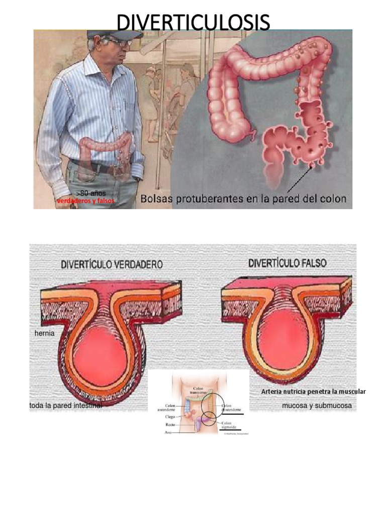 Diverticulo Falso Current Recommendations On Diagnosis And Management