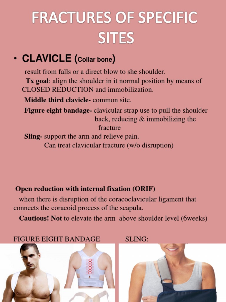 Clavicle (: Result From Falls or A Direct Blow To She Shoulder. CLOSED ...