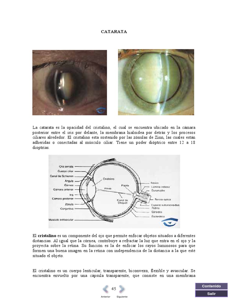 Catarata | Catarata | Oftalmología