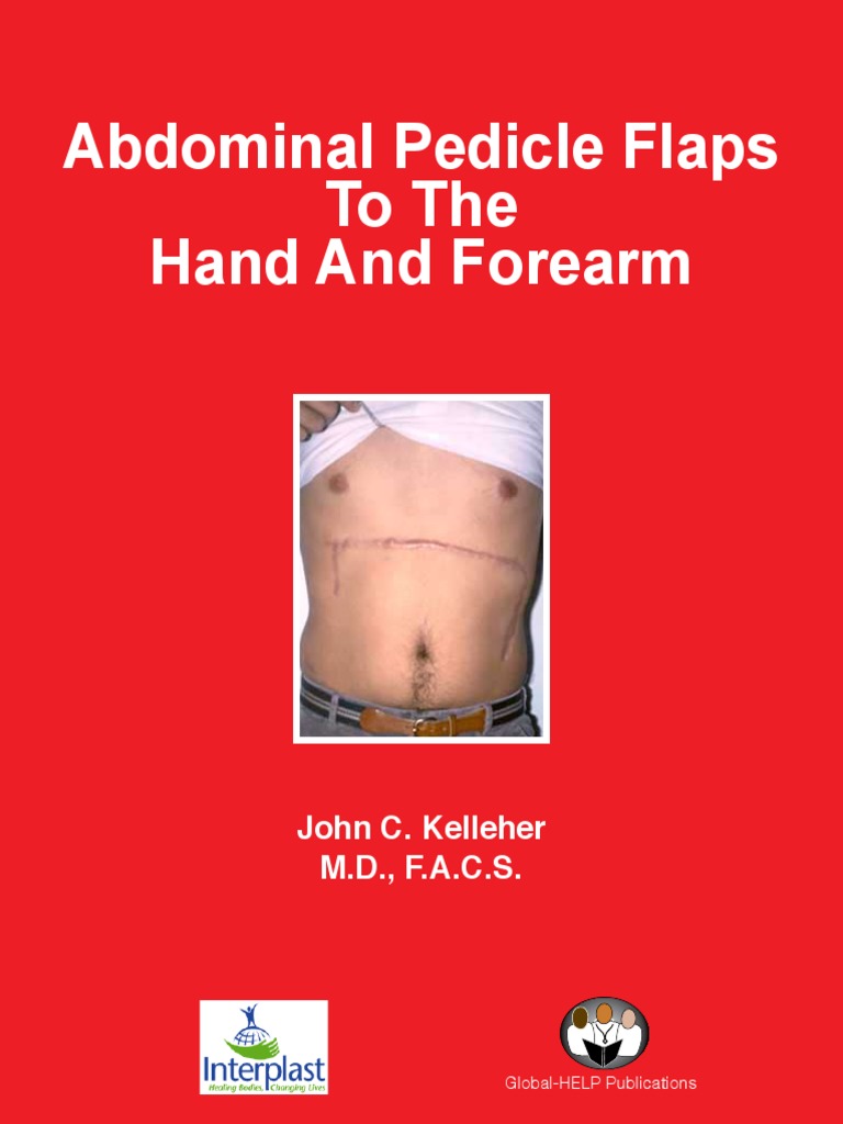 Abdominal Flap PDF | PDF | Finger | Hand