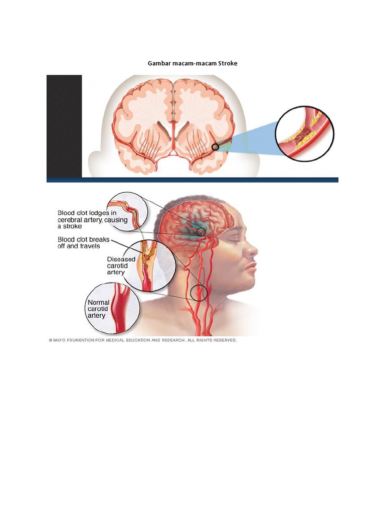 Macam Macam Stroke | PDF