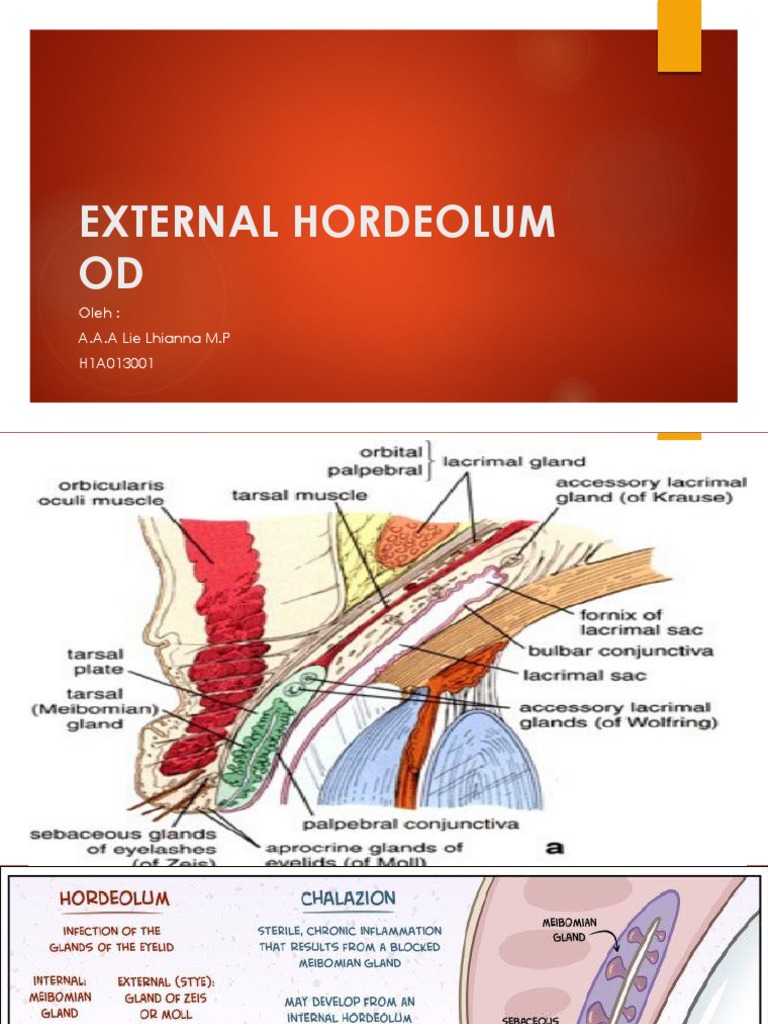 External Hordeolum OD: Oleh: A.A.A Lie Lhianna M.P H1A013001 | PDF ...