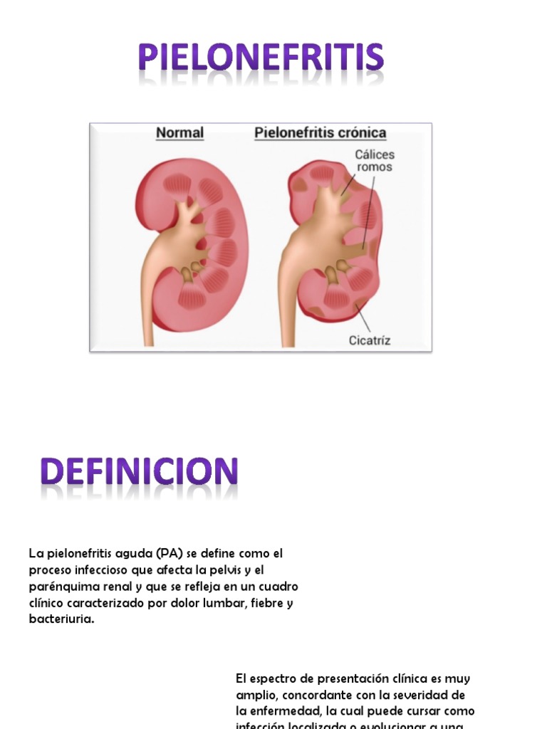 Pielonefritis Aguda: Síntomas y Tratamiento | PDF | Epidemiología ...