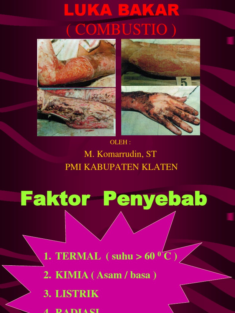 5-luka-bakar.ppt
