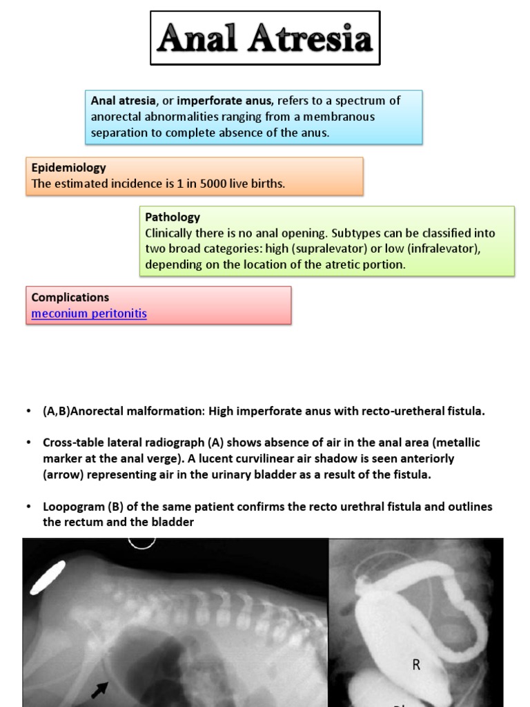 Atresia Ani | PDF