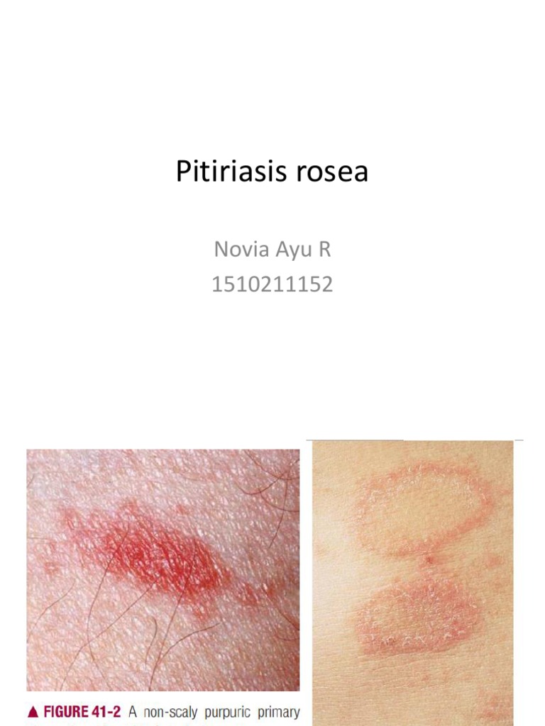 Pitiriasis Rosea | PDF