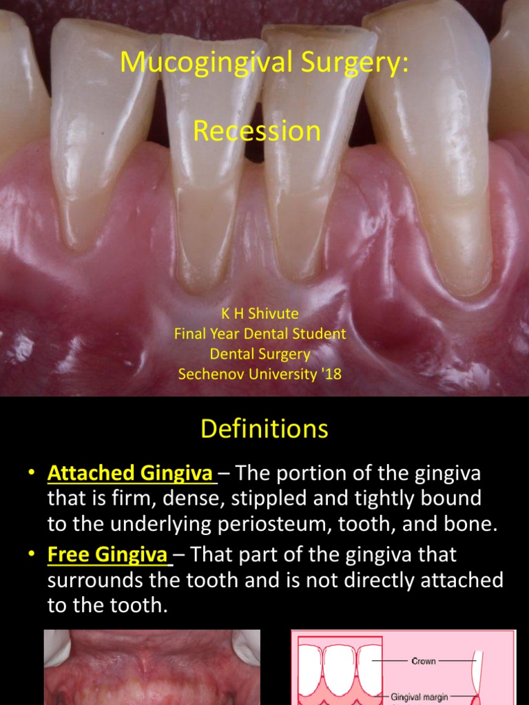 Mucogingival Surgery: Recession: K H Shivute Final Year Dental Student ...