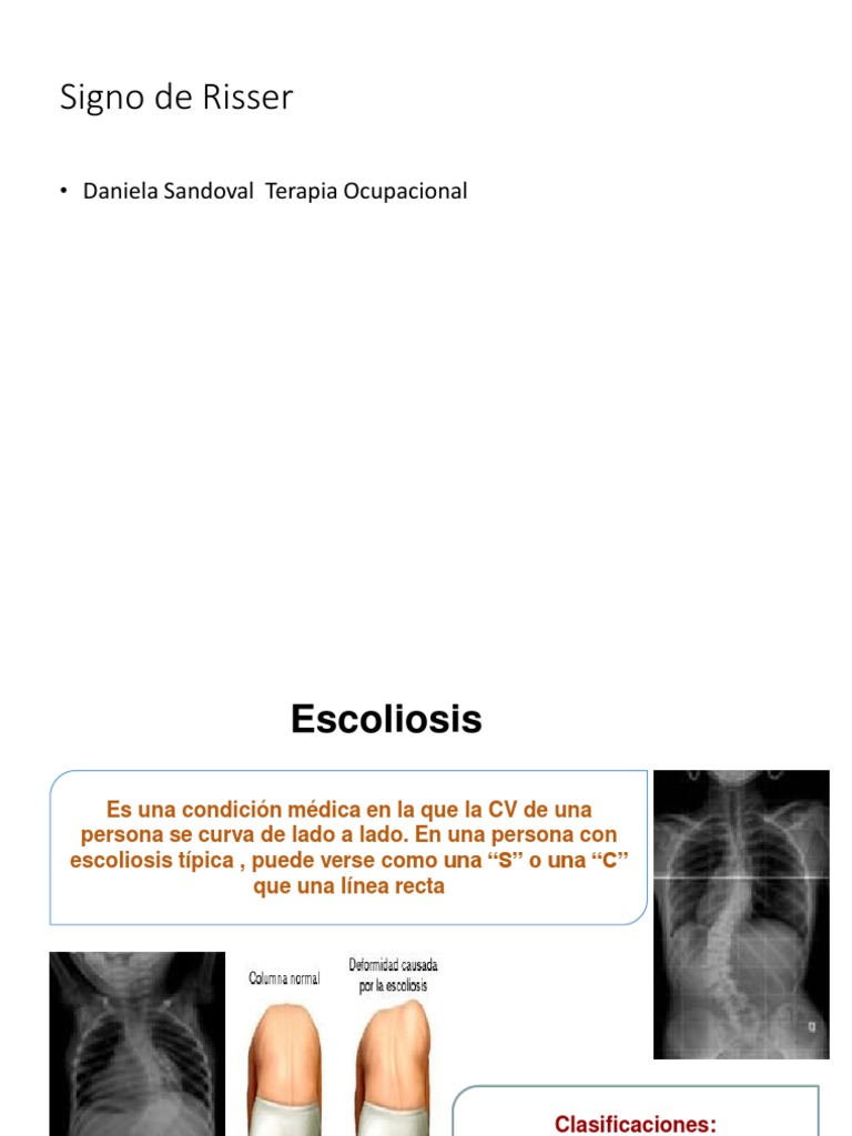 Signo de Risser en Escoliosis | PDF | Escoliosis | Rtt