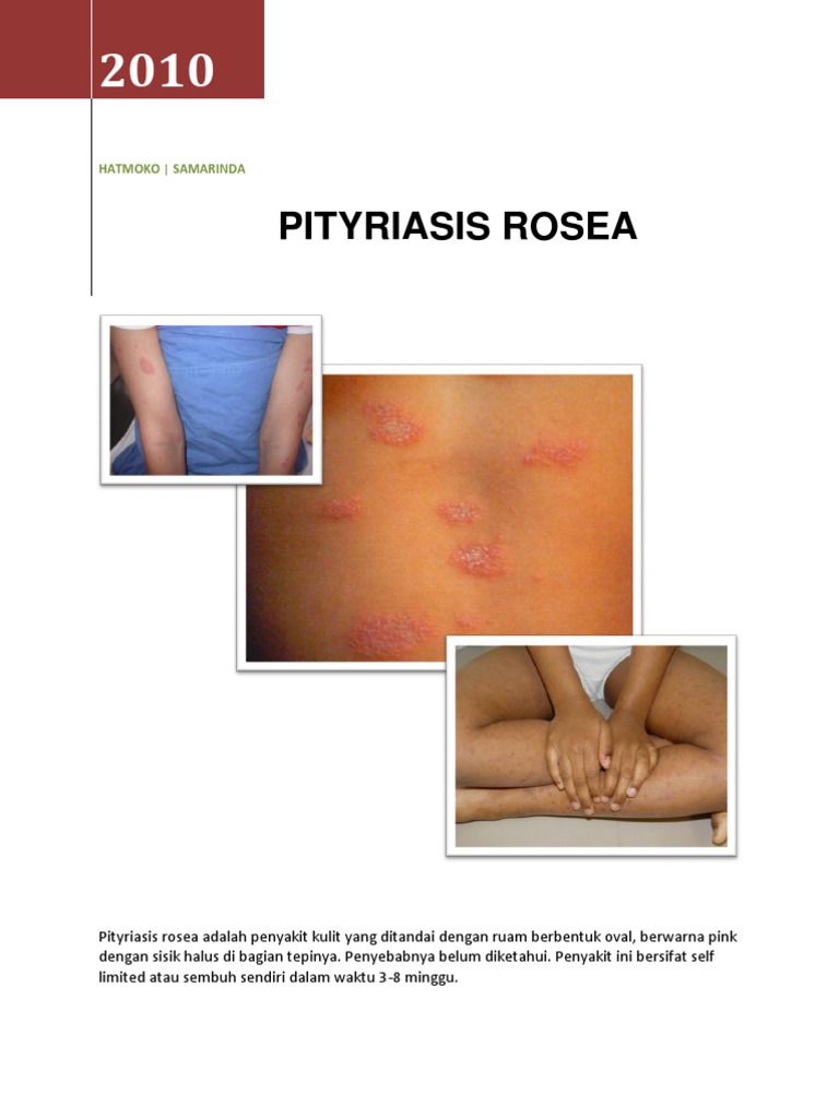 Pityriasis Rosea | PDF