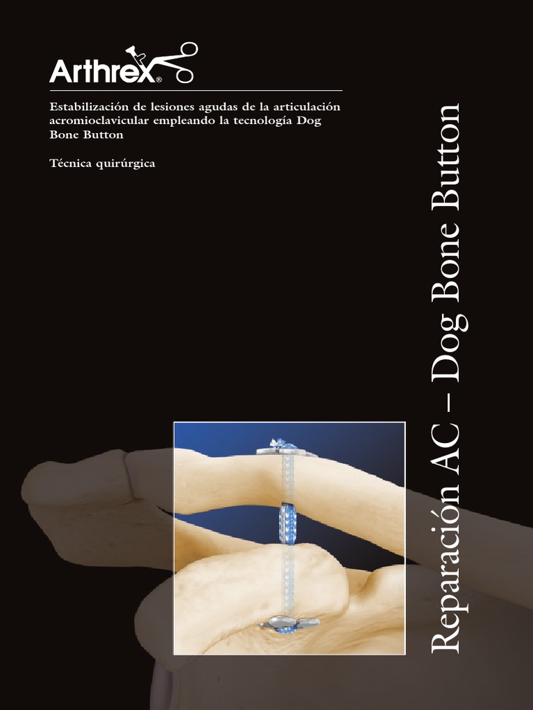 Estabilizacin de Lesiones Agudas de La Articulacin Acromioclavicular ...