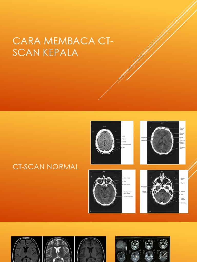 Cara Membaca Hasil CT Scan Kepala | PDF | Griya & Taman | Komputer