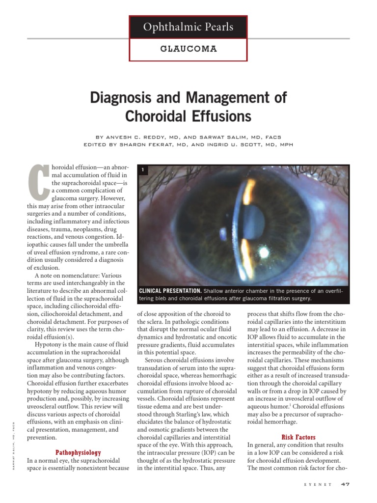 Diagnosis and Management of Choroidal Effusions | PDF | Glaucoma | Cataract