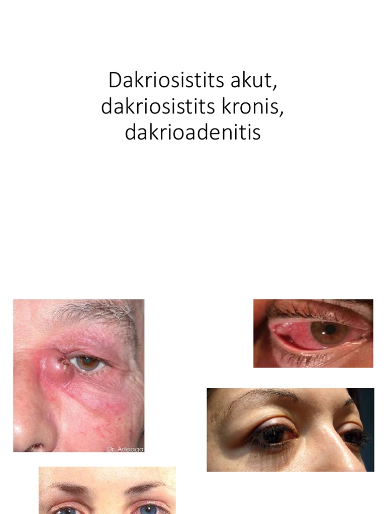Dacryoadenitis and Dacryocystitis Overview | PDF | Epidemiology ...