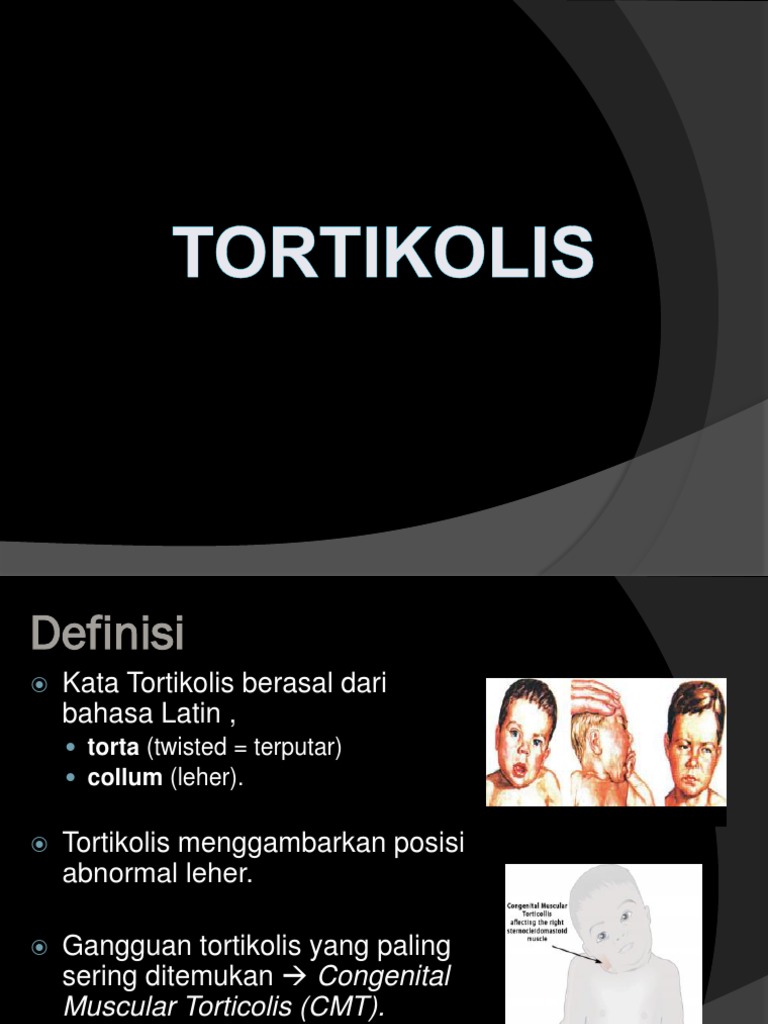 Tatalaksana Tortikolis Kongenital | PDF