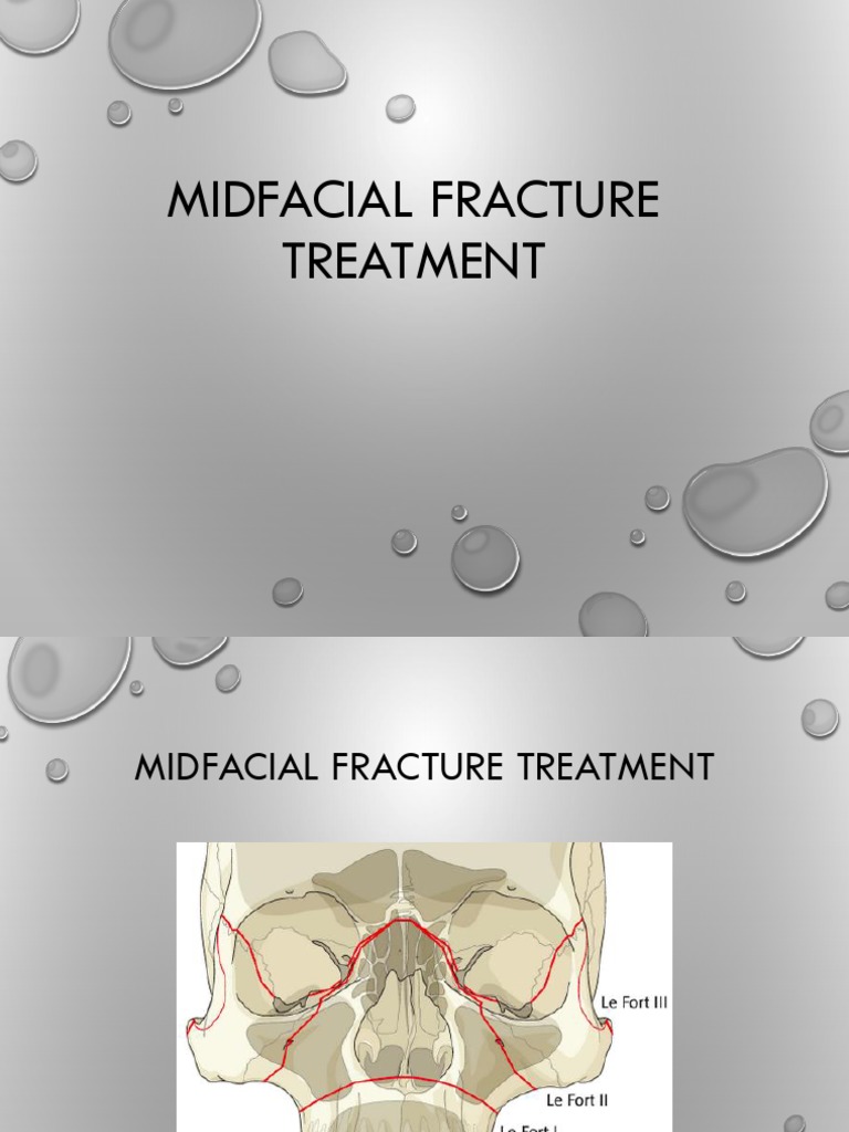 Midfacial Fracture Treatment | PDF | Dental Implant | Dentistry Branches