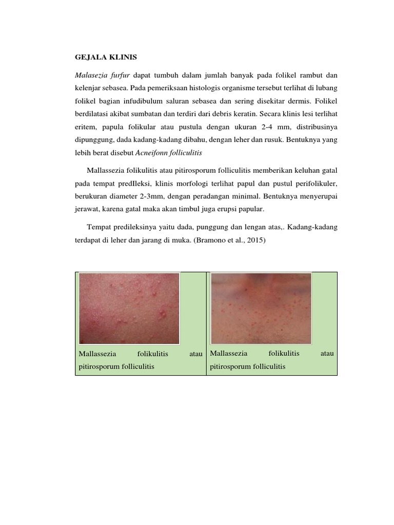 Folikulitis Malassezia: Diagnosis dan Gejala | PDF