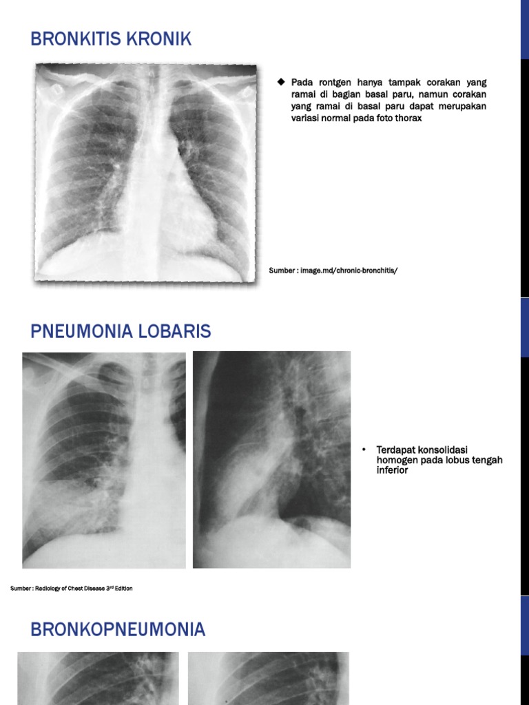 Radiologi Infeksi Pada Paru | PDF