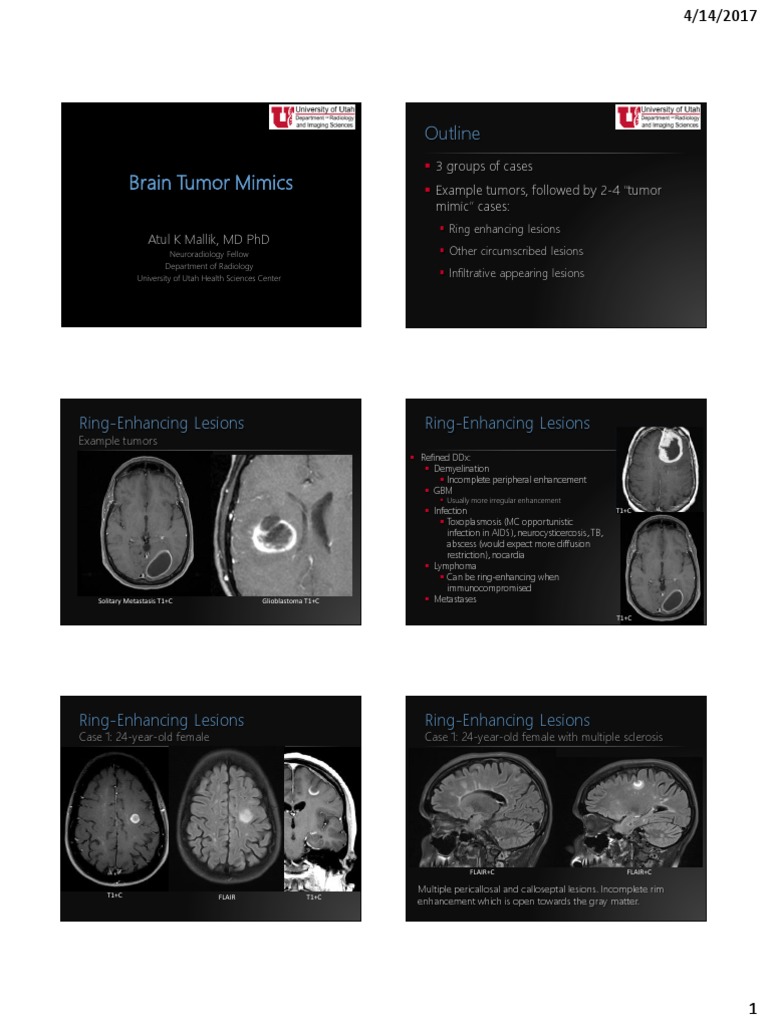 Tumor Mimic Imaging | PDF | Cerebral Cortex | Human Anatomy