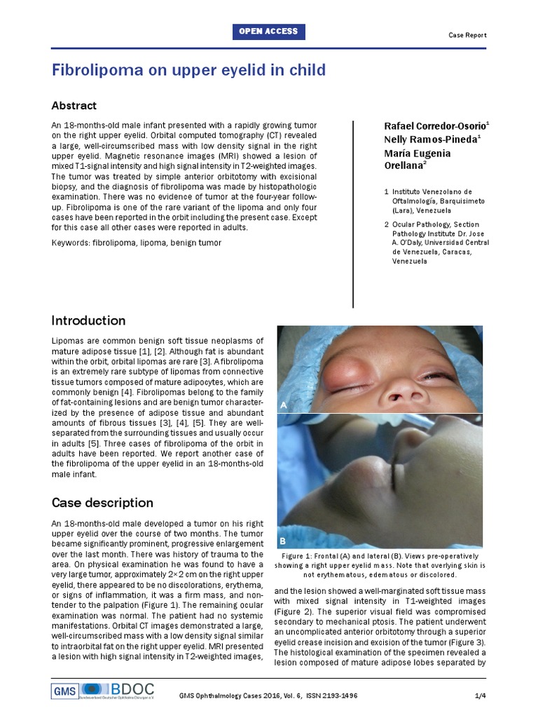 Fibrolipoma On Upper Eyelid in Child: Rafael Corredor-Osorio Nelly ...