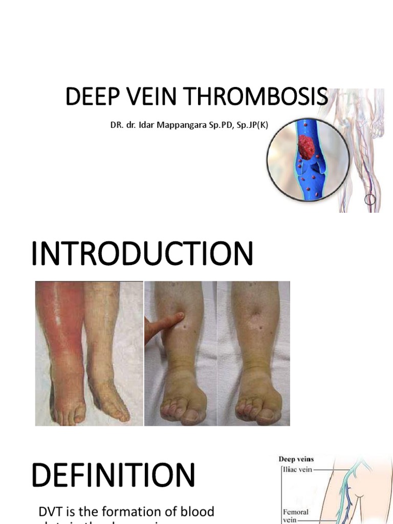 DVT slide | Thrombosis | Medical Specialties