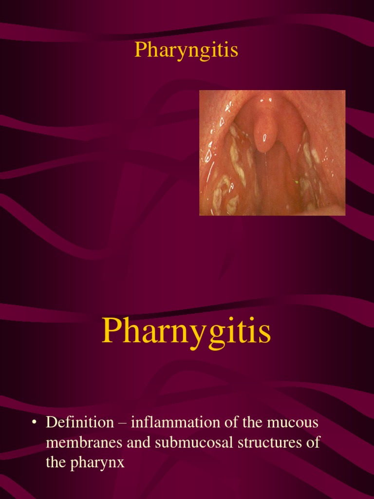 Understanding Pharyngitis: Causes & Treatment | PDF | Candidiasis ...