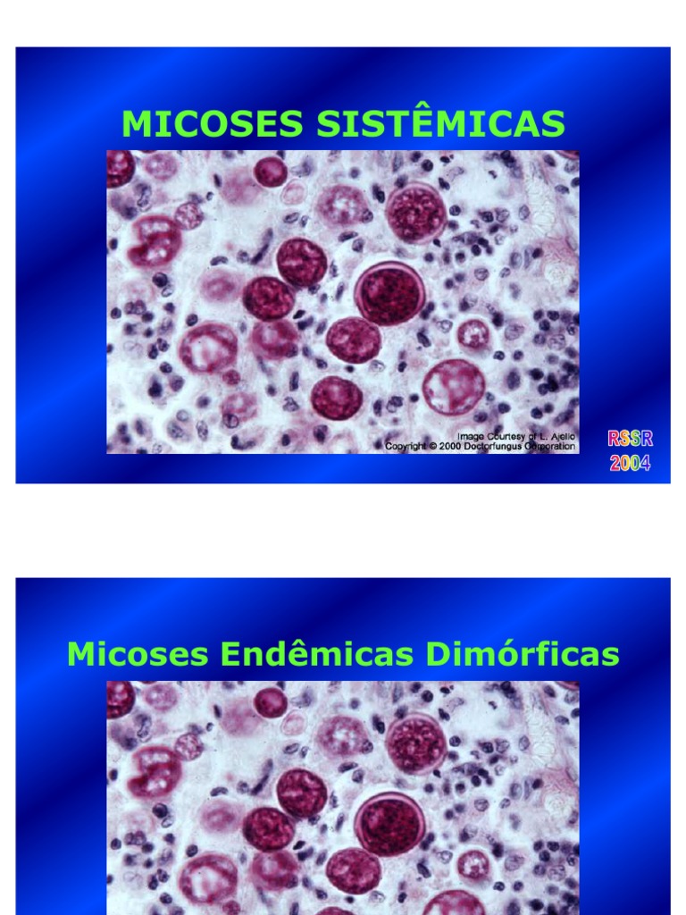 Micoses Profundas.ppt (Micoses) | Fungo | Patologia | Avaliação ...