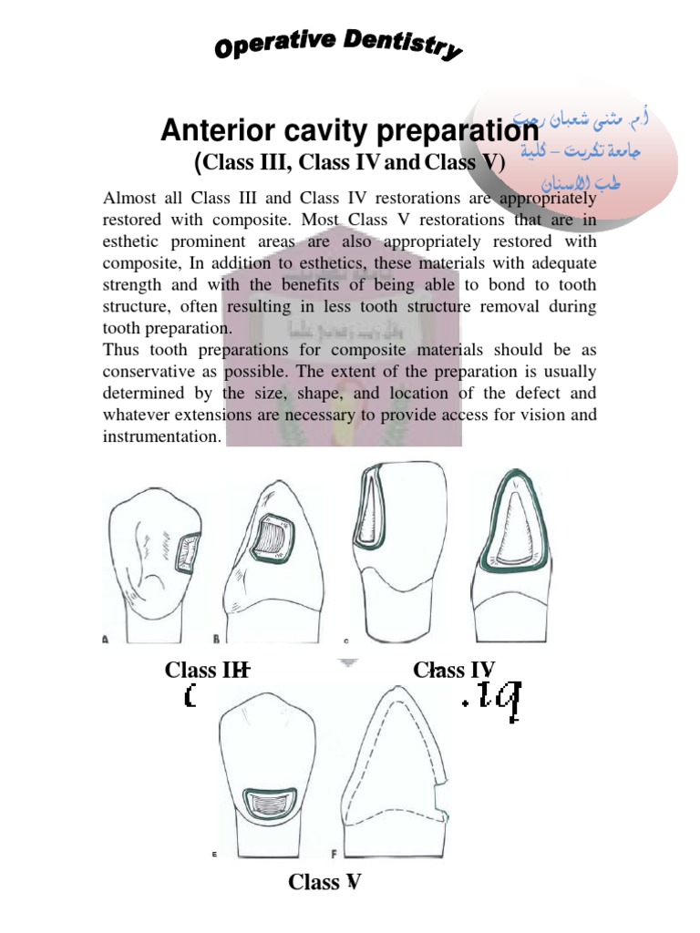 Anterior Cavity Preparation: (Class III, Class IV and Class V ...