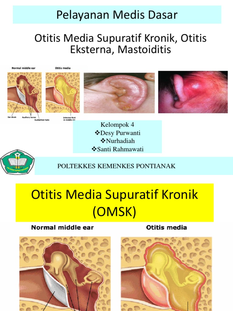 Otitis Media Supuratif Kronik (OMSK).pptx