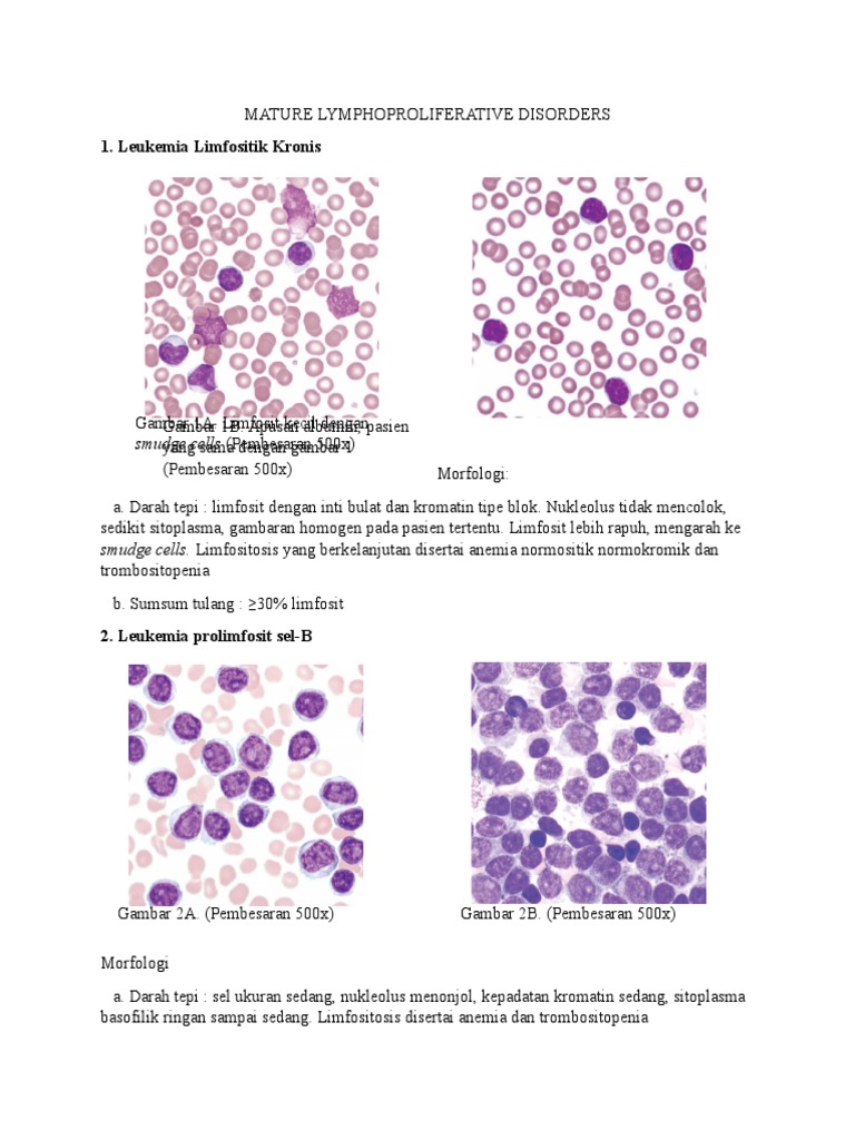 Mature Lymphoproliferative Disorders | PDF