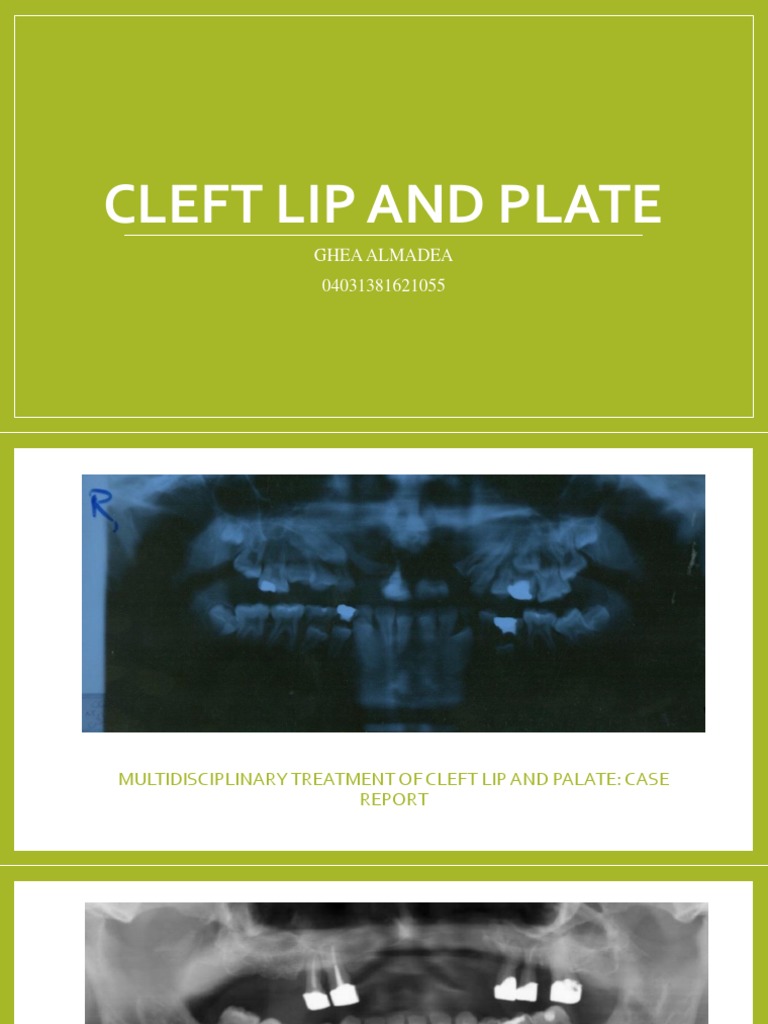 Cleft Lip and Plate | PDF | Science & Mathematics