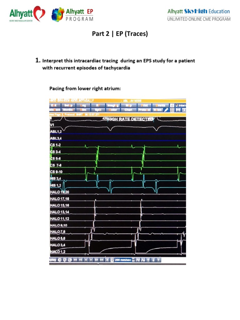 Part 02 EP Tracings | Download Free PDF | Artificial Cardiac Pacemaker ...