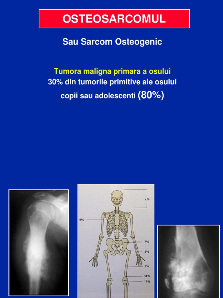 Osteosarcomul: Sau Sarcom Osteogenic | PDF