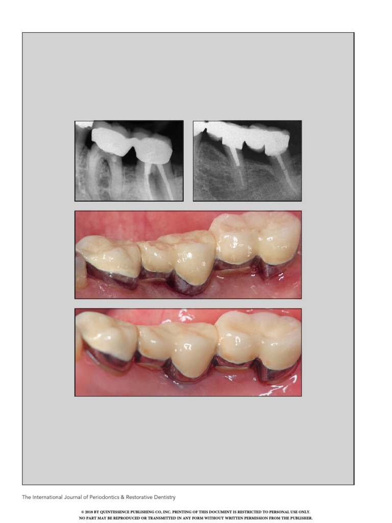 Root Resection and Hemisection Revisited. Part II - A Retrospective ...
