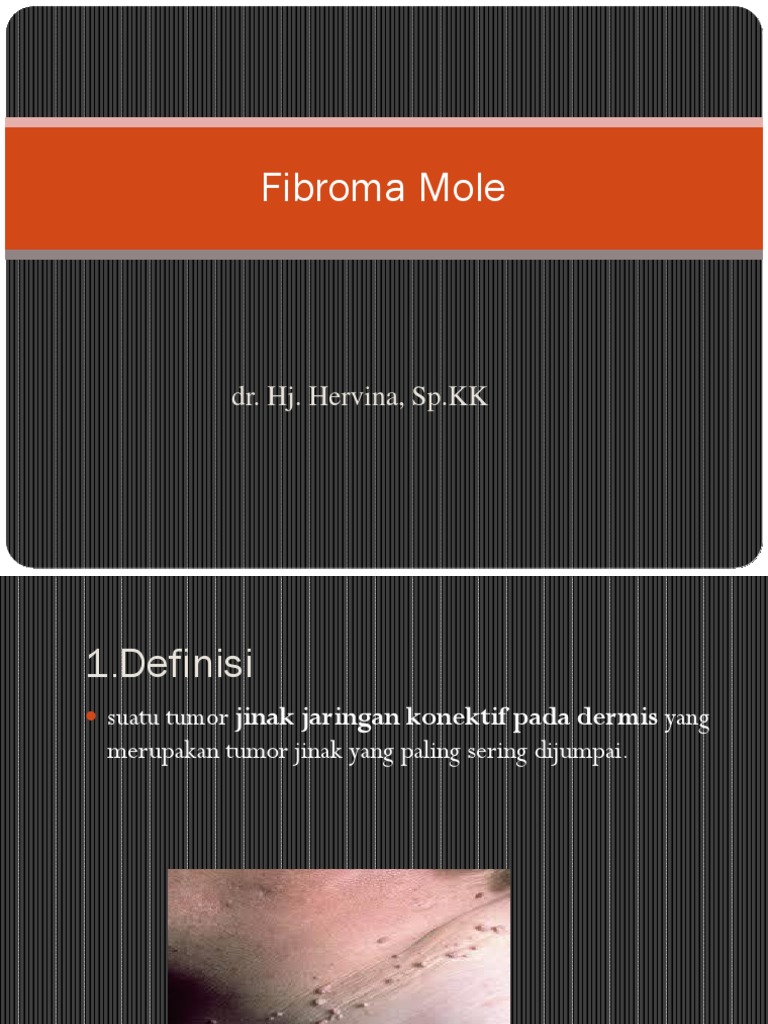 SKIN TAG: A BENIGN CONNECTIVE TISSUE TUMOR OF THE DERMIS | PDF