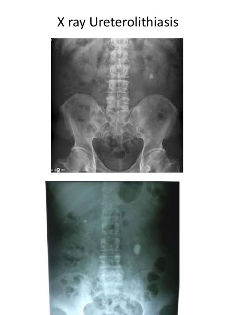 X Ray Uretero-Vesicolithiasis | PDF