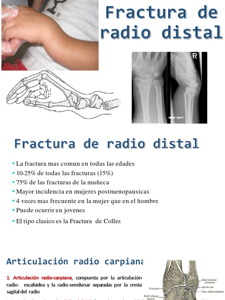 Fractura de Radio Distal | PDF | Sistema esquelético | Sistema ...