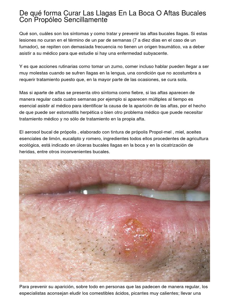 De qué forma Curar Las Llagas En La Boca O Aftas Bucales Con Propóleo Sencillamente | Ciencias ...