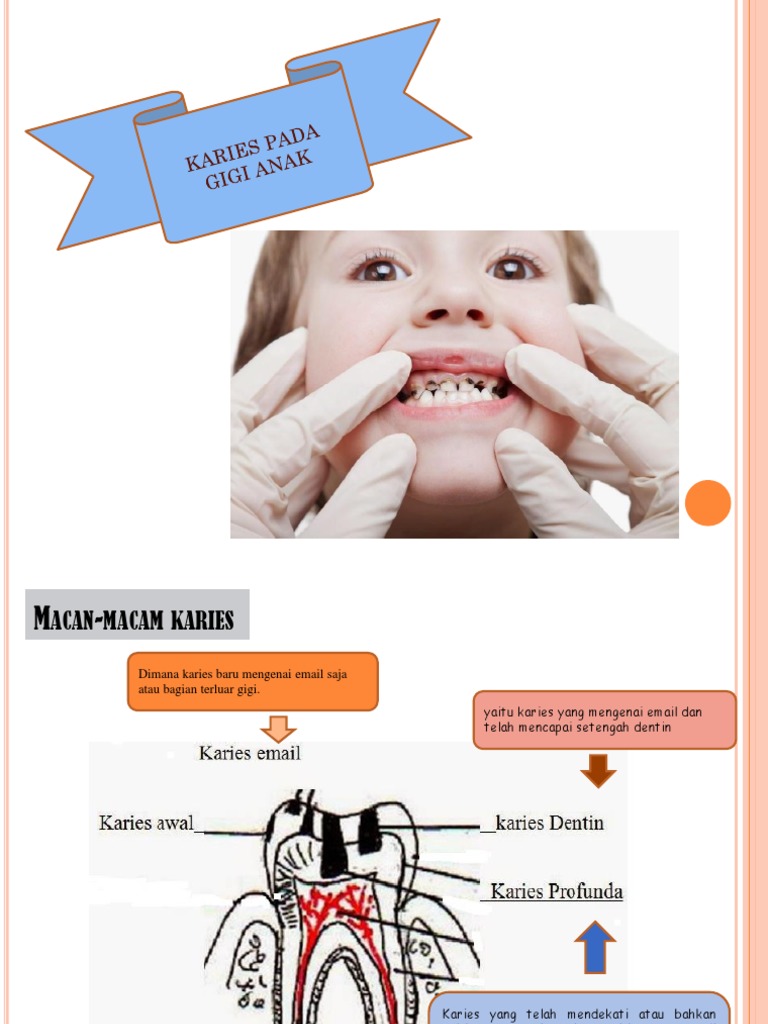 Ppt. Karies Gigi Anak | PDF