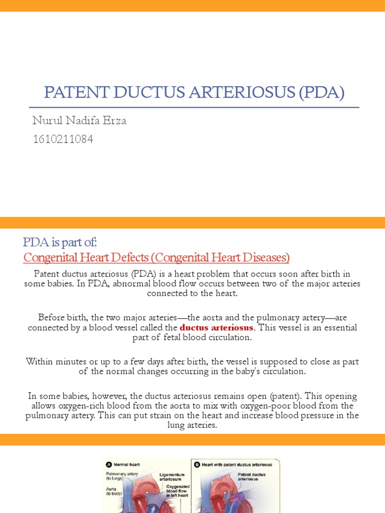 Patent Ductus Arteriosus (PDA) | PDF | Circulatory System | Lung
