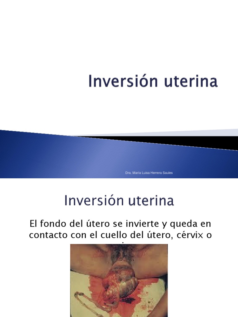 1 Inversion Uterina | PDF | Útero | Sistema Reproductor Femenino Mamífero