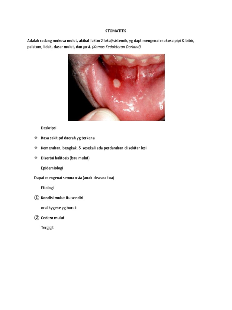 Stomatitis | PDF