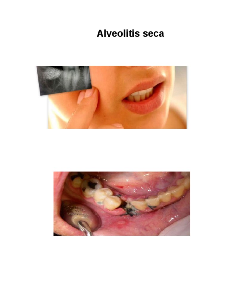 Alveolitis Seca | Sangre | Hueso