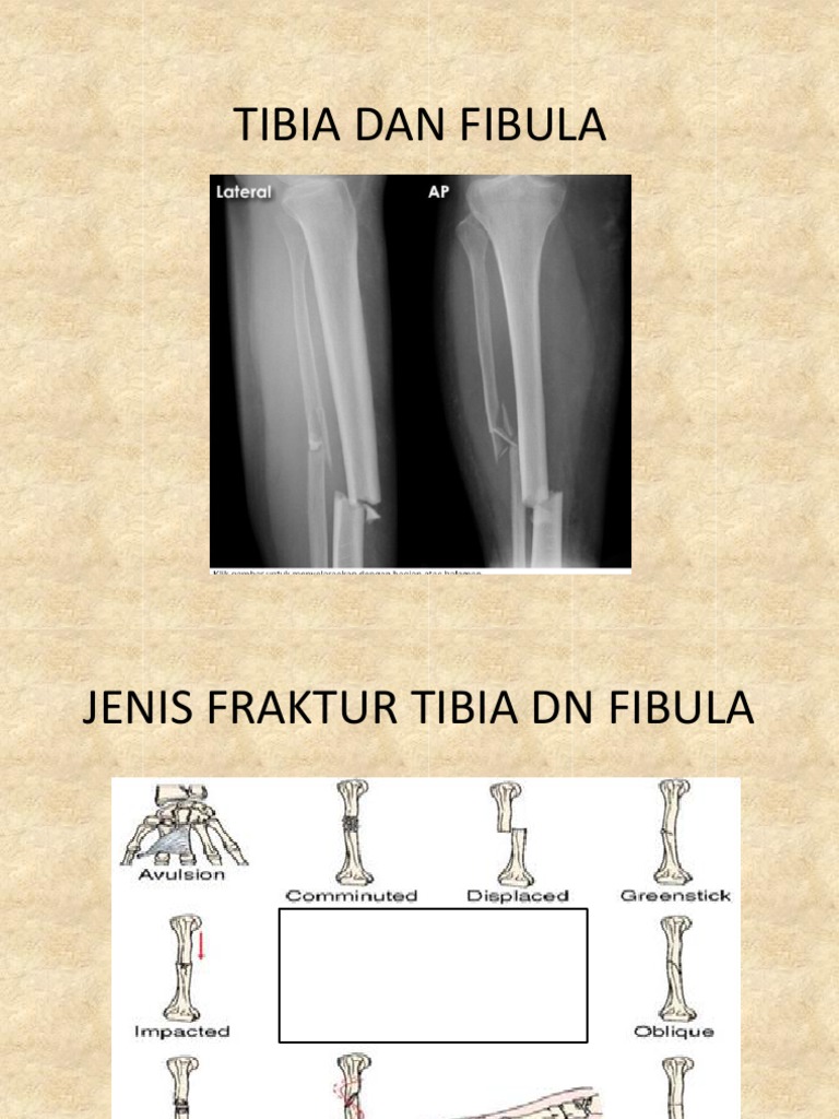 Tibia Dan Fibula | PDF