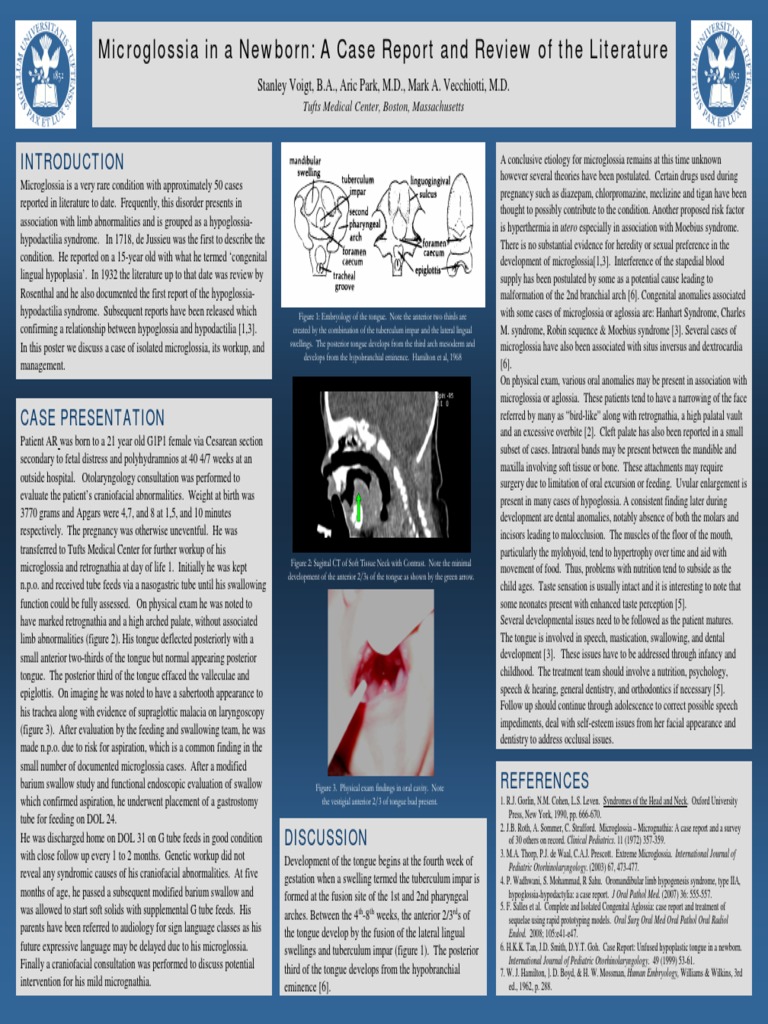 Microglossia in A Newborn: A Case Report and Review of The Literature ...