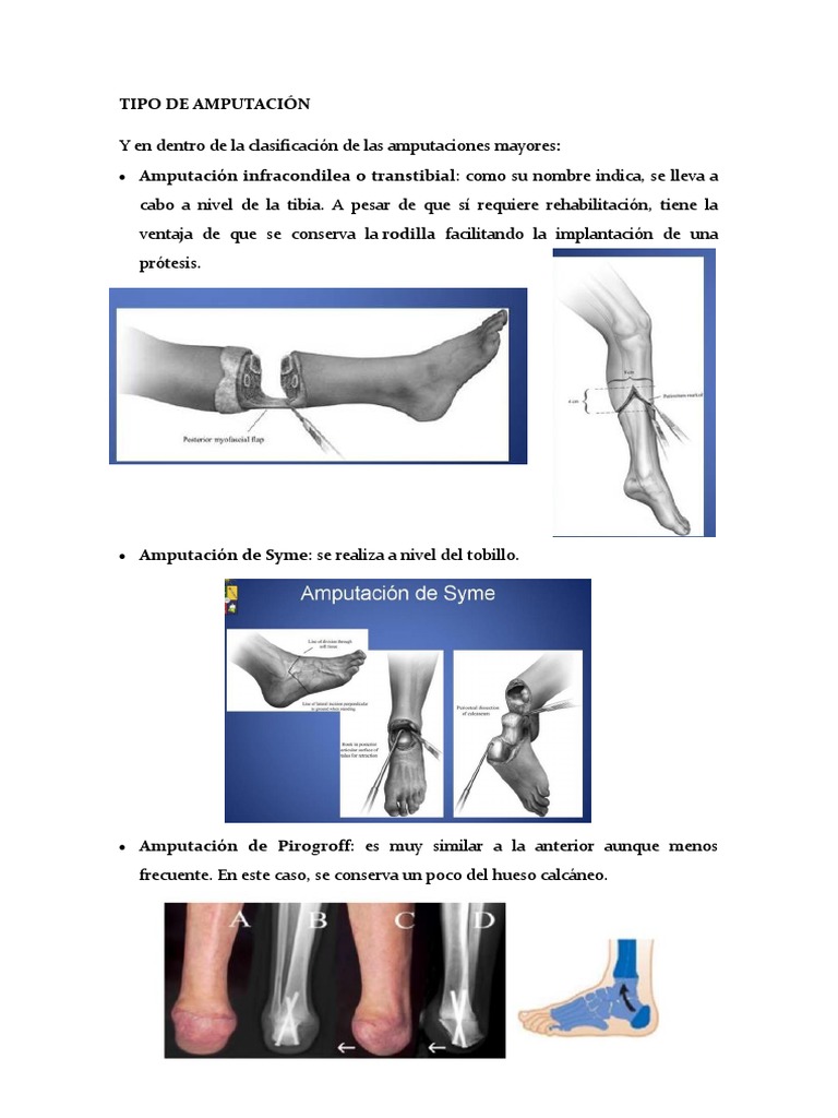 Tipo de Amputación | PDF