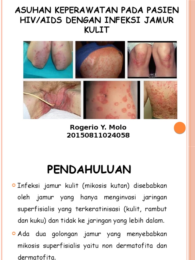 (PPT) Asuhan Keperawatan Pada Pasien HIV/AIDS Dengan Infeksi Jamur ...